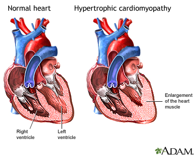Cardiomyopathy - Soliman Care Family Practice Center Inc