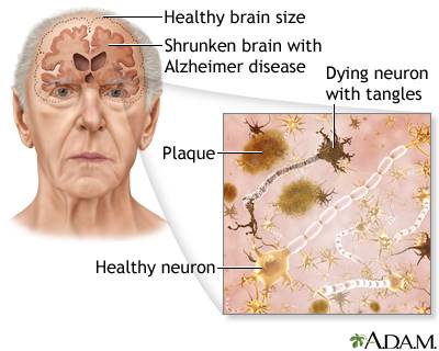 Alzheimer's Disease - Soliman Care Family Practice Center Inc